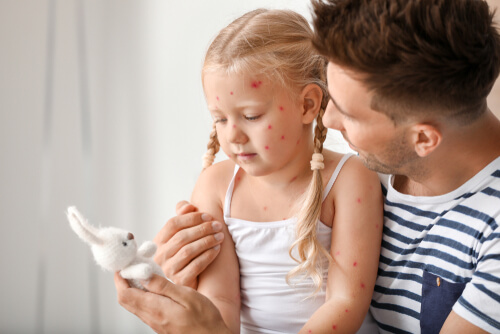 Chickenpox vaccine 2026 | Chickenpox in children